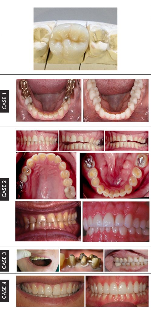 Authentic Dental Laboratory | Restorations